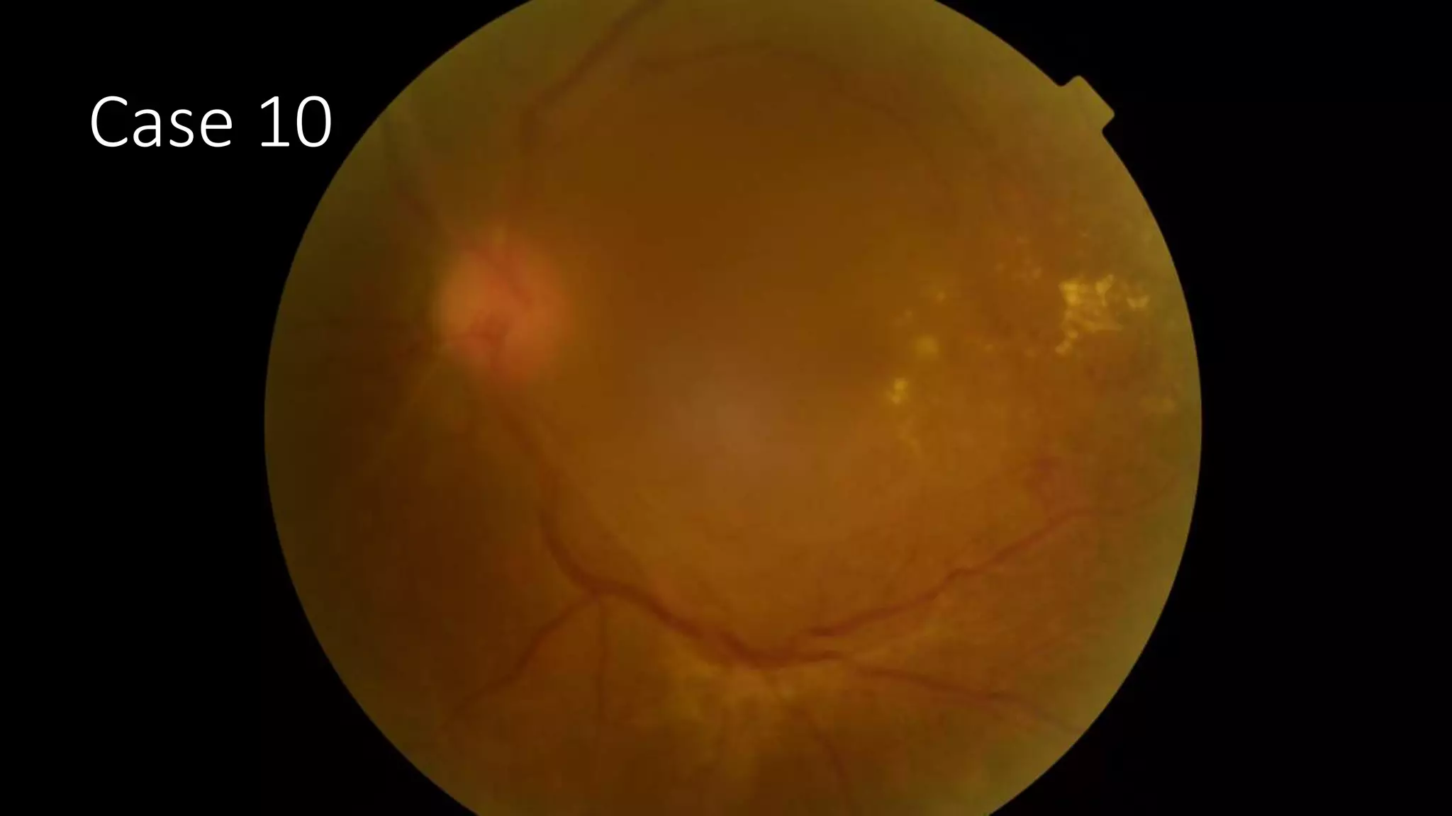 PRE-TEST: Detection of diabetic retinopathy using fundus photos online ...