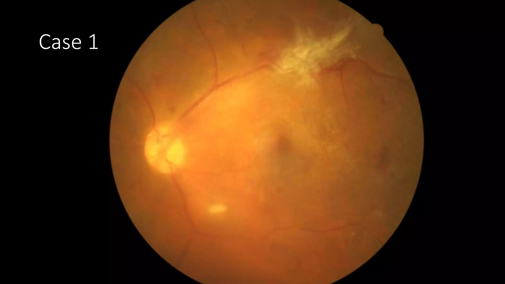 PRE-TEST: Detection of diabetic retinopathy using fundus photos online ...