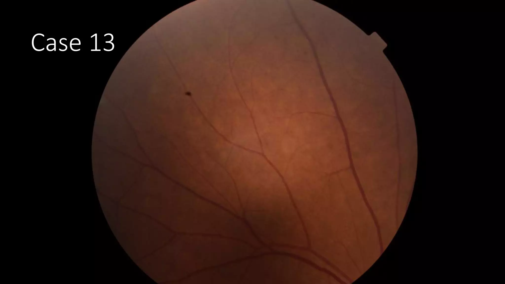 Pre Test Detection Of Diabetic Retinopathy Using Fundus Photos Online Quiz Pptx Eye And