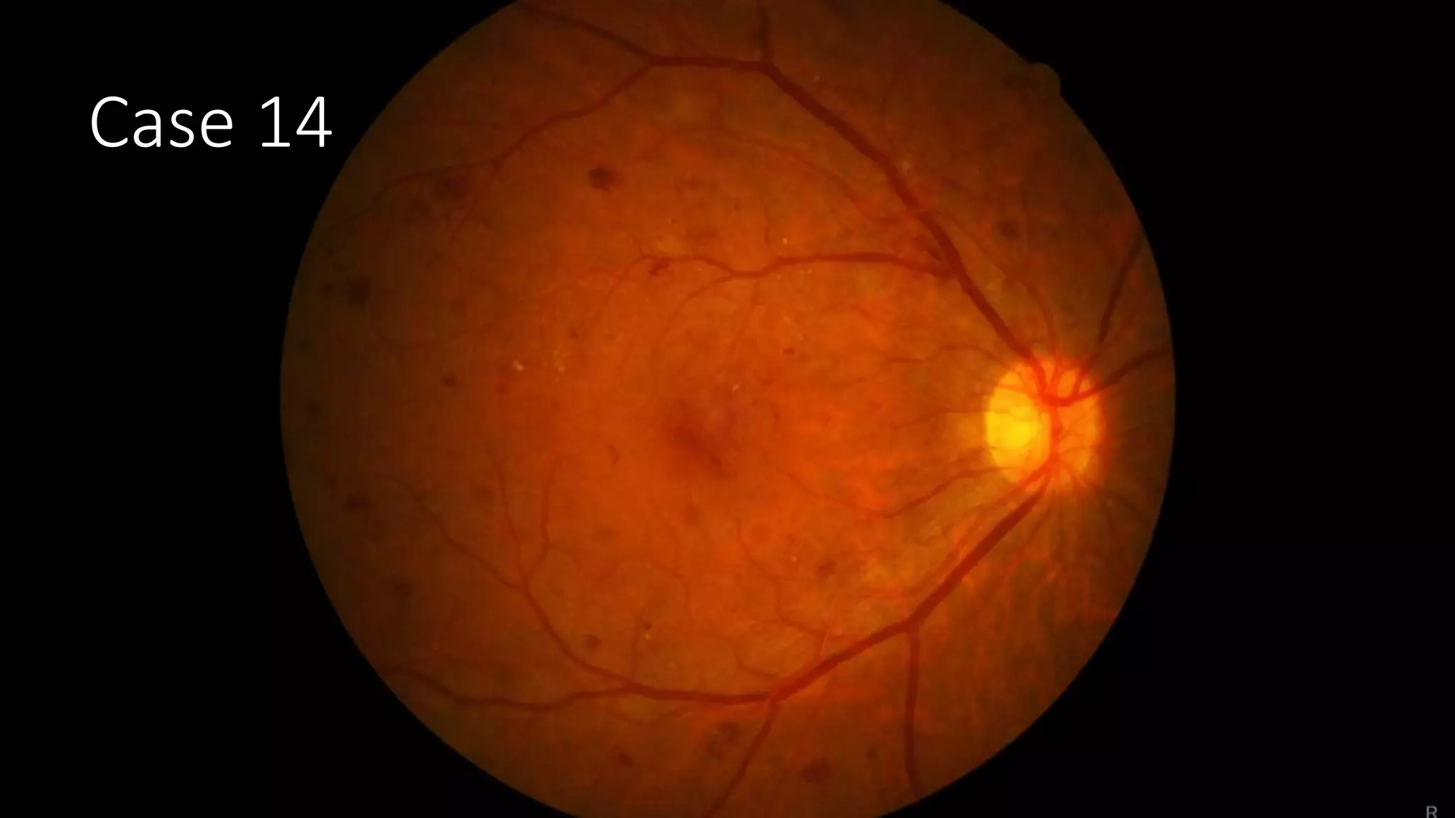 Pre Test Detection Of Diabetic Retinopathy Using Fundus Photos Online Quiz Pptx Eye And