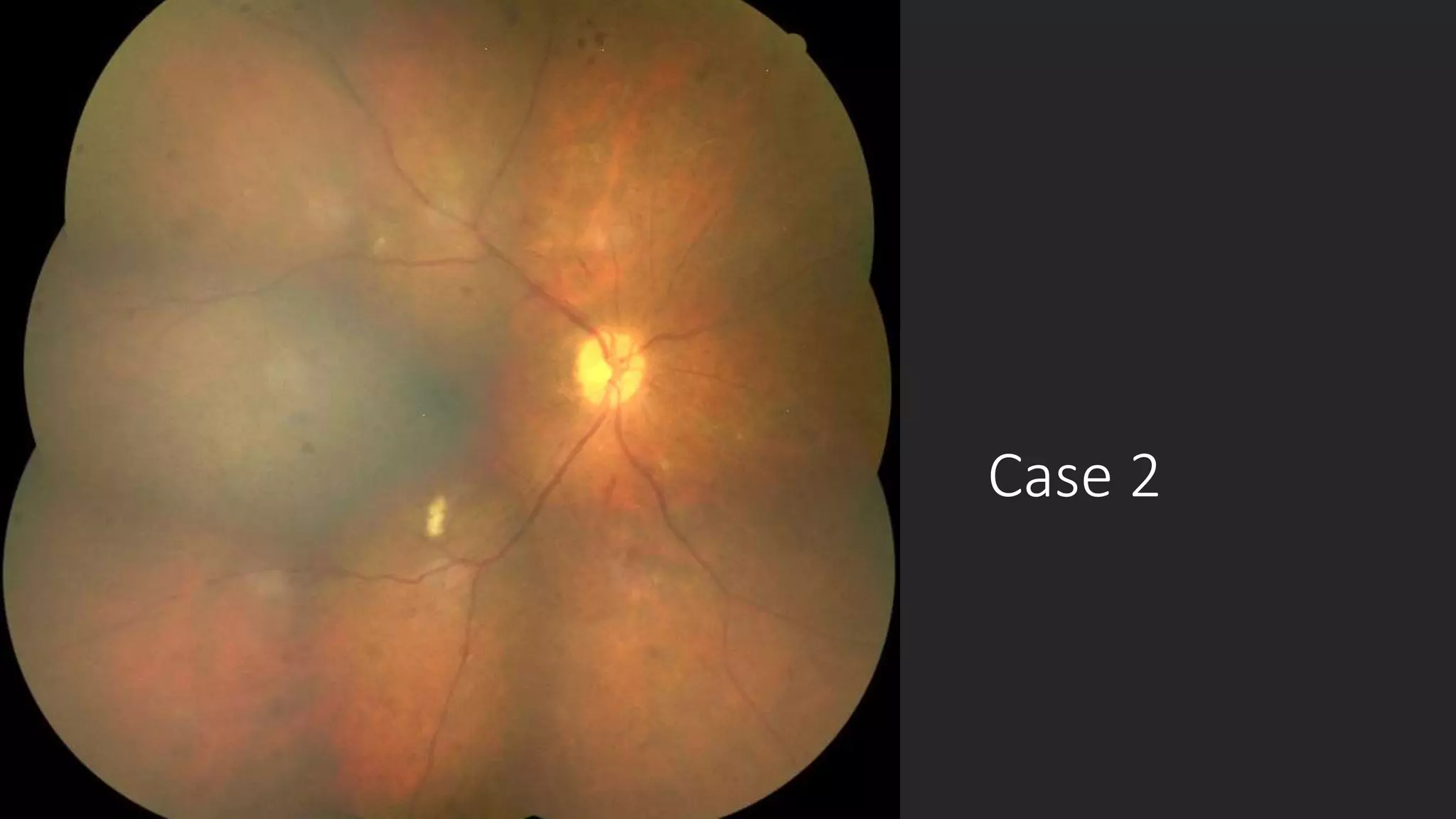 PRE-TEST: Detection of diabetic retinopathy using fundus photos online ...