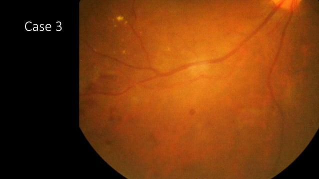 PRE-TEST: Detection of diabetic retinopathy using fundus photos online ...