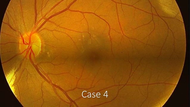 Pre Test Detection Of Diabetic Retinopathy Using Fundus Photos Online Quiz Pptx Eye And