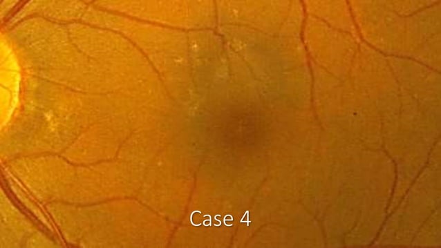 PRE-TEST: Detection of diabetic retinopathy using fundus photos online ...