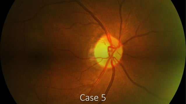 PRE-TEST: Detection of diabetic retinopathy using fundus photos online ...