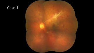 PRE-TEST: Detection of diabetic retinopathy using fundus photos online ...
