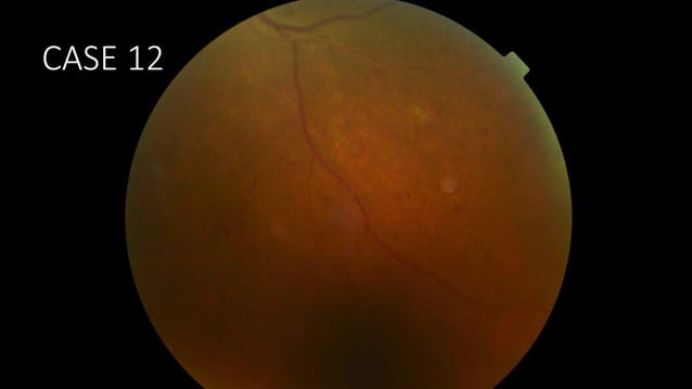 PRE-TEST: Detection of diabetic retinopathy using fundus photos online ...
