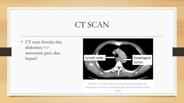deteksi dini kanker esofagus.pptx