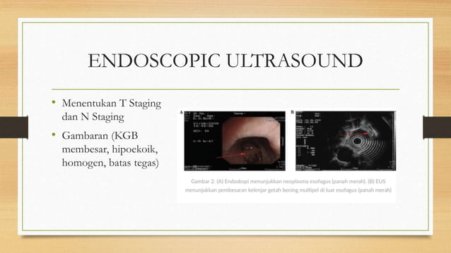 deteksi dini kanker esofagus.pptx