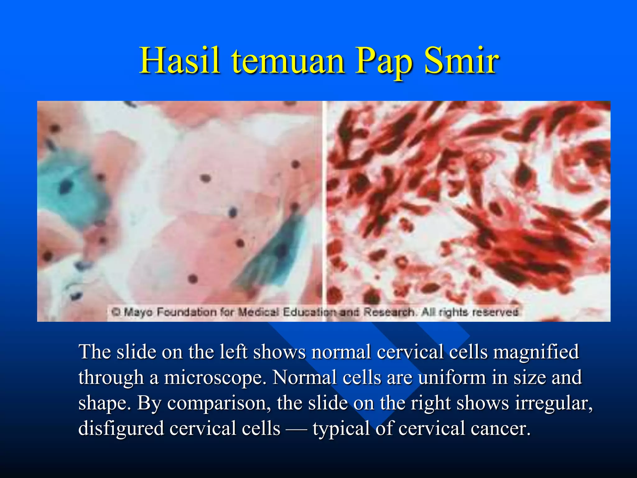 Kanker Serviks | PPT