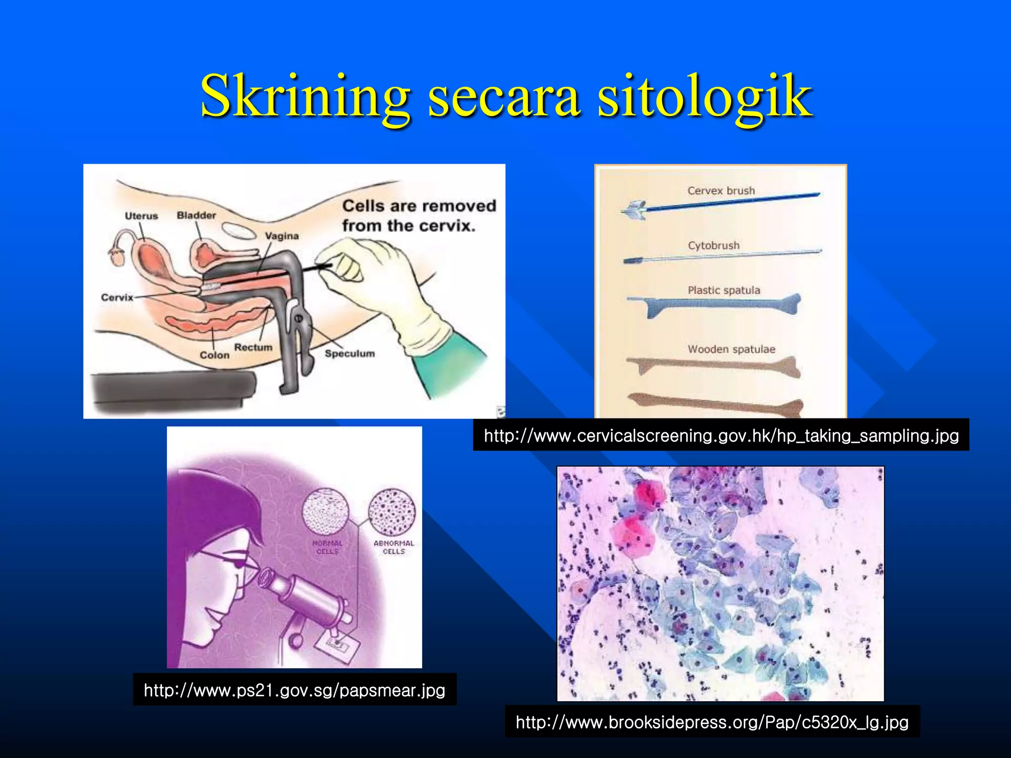 Kanker Serviks | PPT
