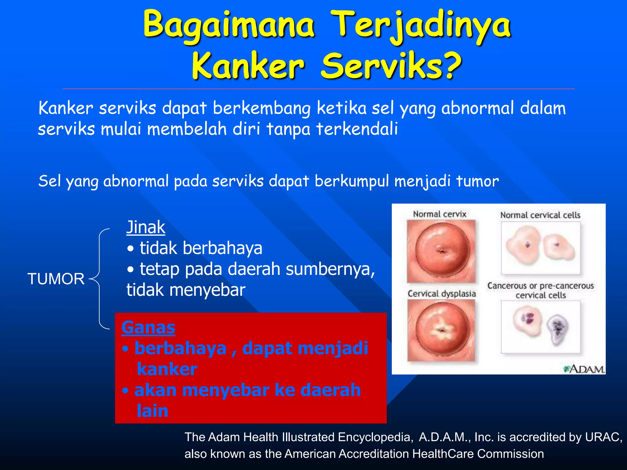 Kanker Serviks | PPT