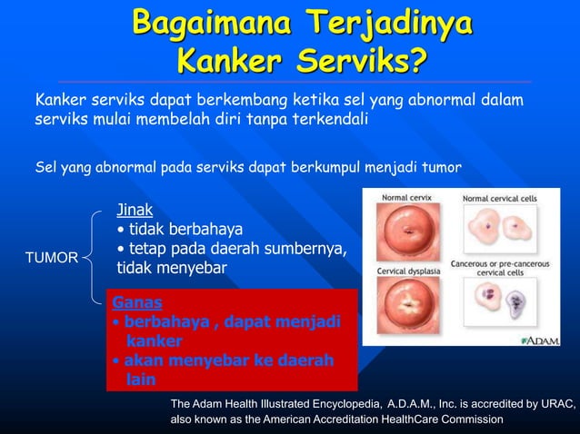Kanker Serviks | PPT