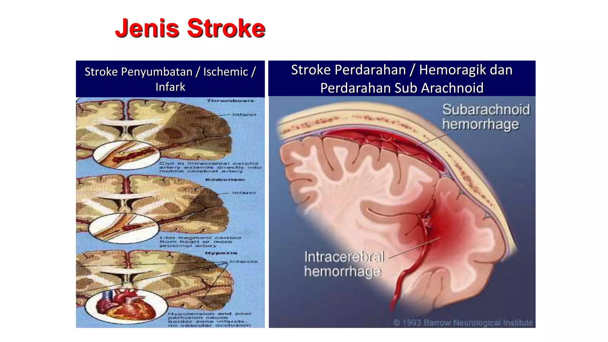 Deteksi dini stroke hemoragik.pptx