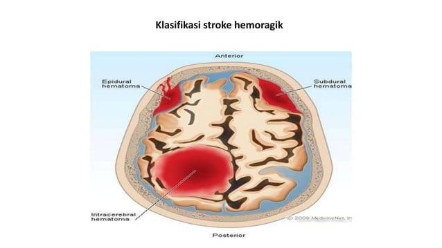 Deteksi dini stroke hemoragik.pptx