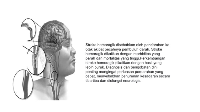 Deteksi dini stroke hemoragik.pptx