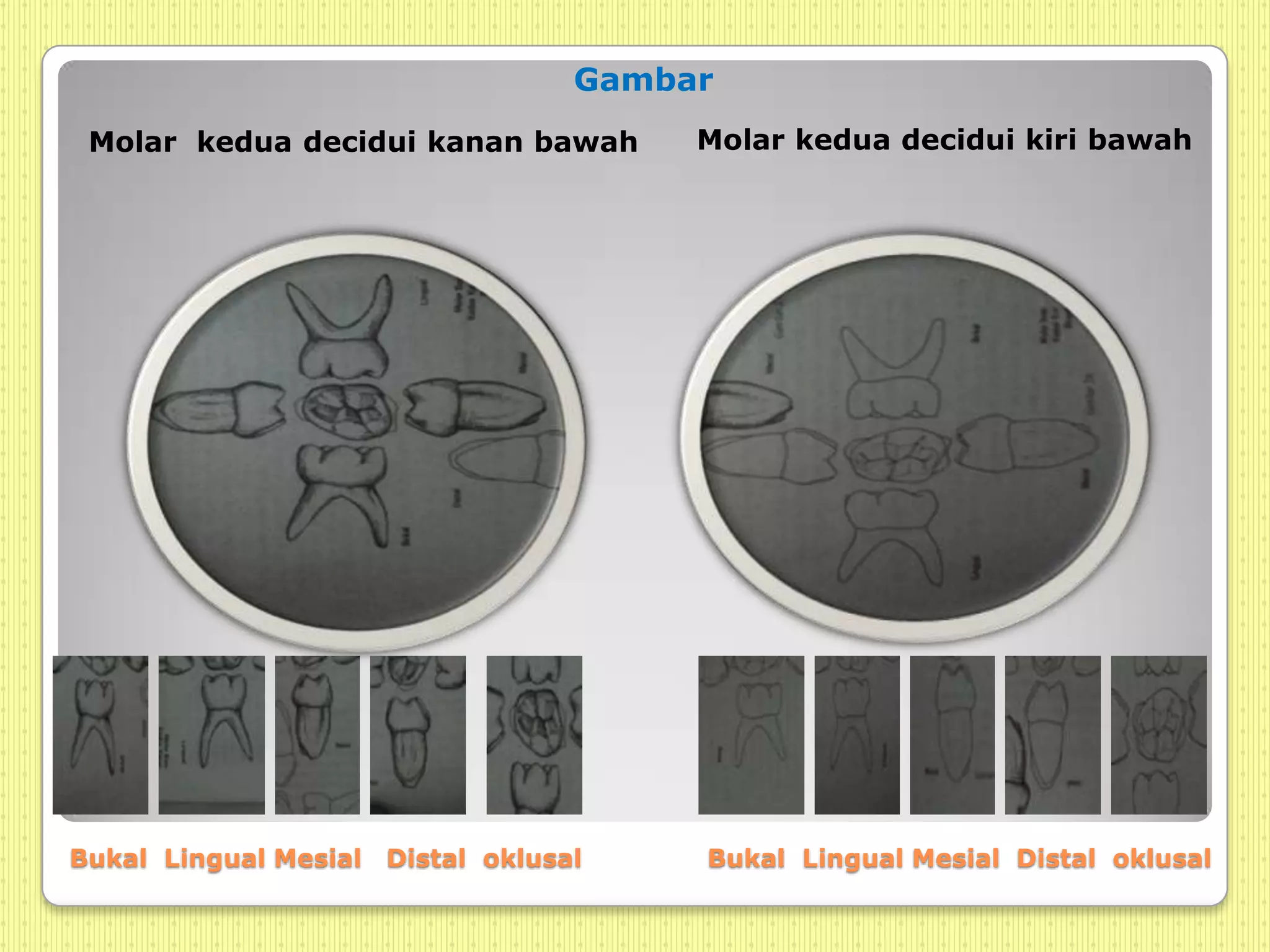 Determinasi gigi molar decidui bawah syiiiik | PPTX