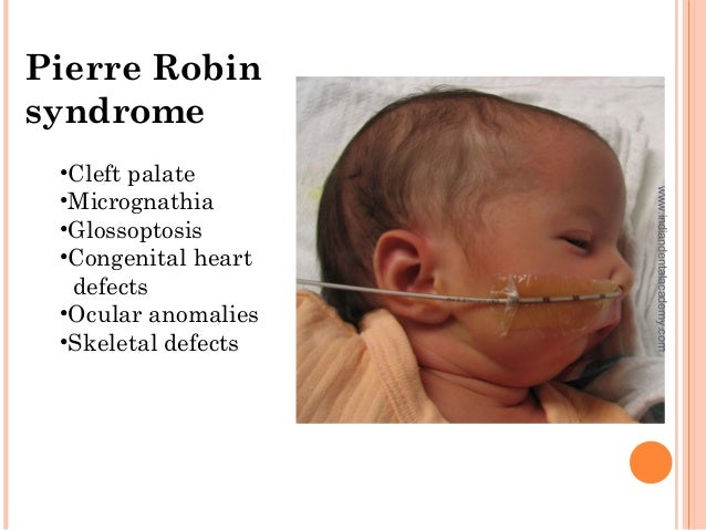 DEVELOPMENTAL DISTURBANCES OF JAWS & DENTAL ARCH / oral surgery cours…