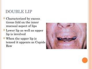 DEVELOPMENTAL DISTURBANCES OF LIPS & PALATE / dental implant courses | PPT