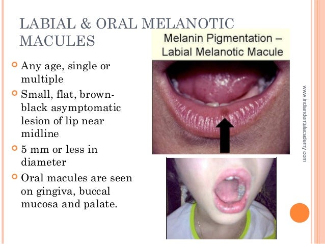 DEVELOPMENTAL DISTURBANCES OF LIPS & PALATE / dental implant courses