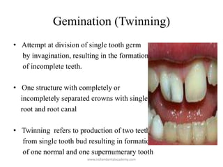 Developmental Disturbances of Oral & Paraoral structures-3 ...