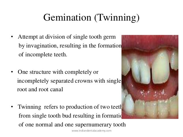Developmental Disturbances of Oral & Paraoral structures-3 /prosthodo…