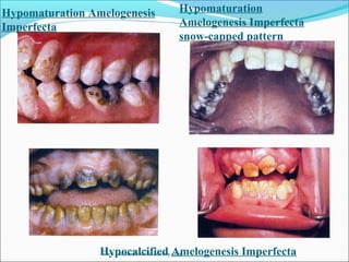 Developmental disturbances in structure of teeth Amelogenesis ...
