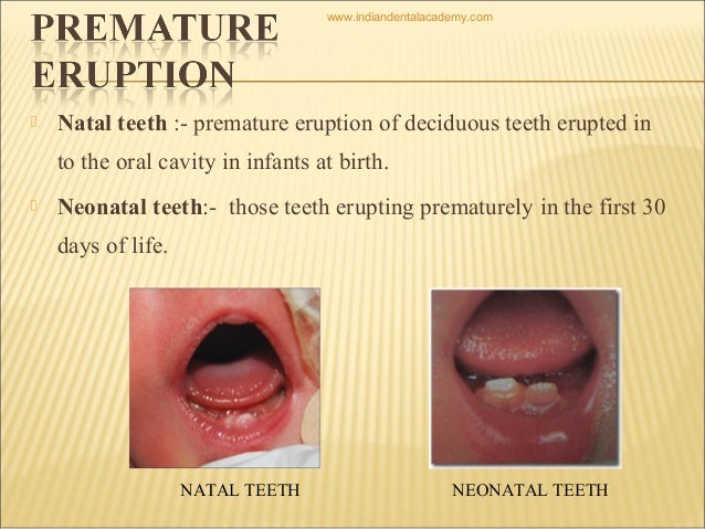 Disturbances of growth of (Eruption) of teeth