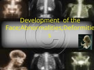DEVELOPMENT of face n Craniofacial system AND ABNORMALITIES OF ...