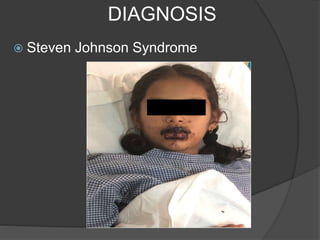 Adverse Drug Reaction: Steven Johnson Syndrome | PPT