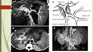 Devascularization in portal hypertension.dr quiyum | PPTX