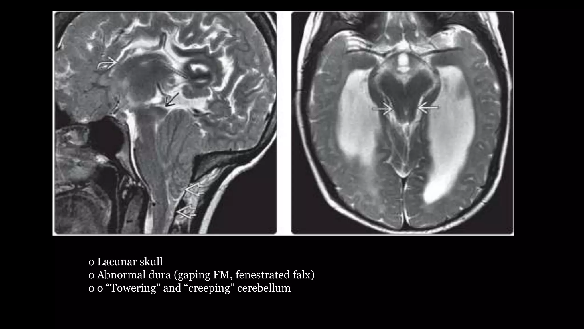 congenital brain anomalies | PPTX