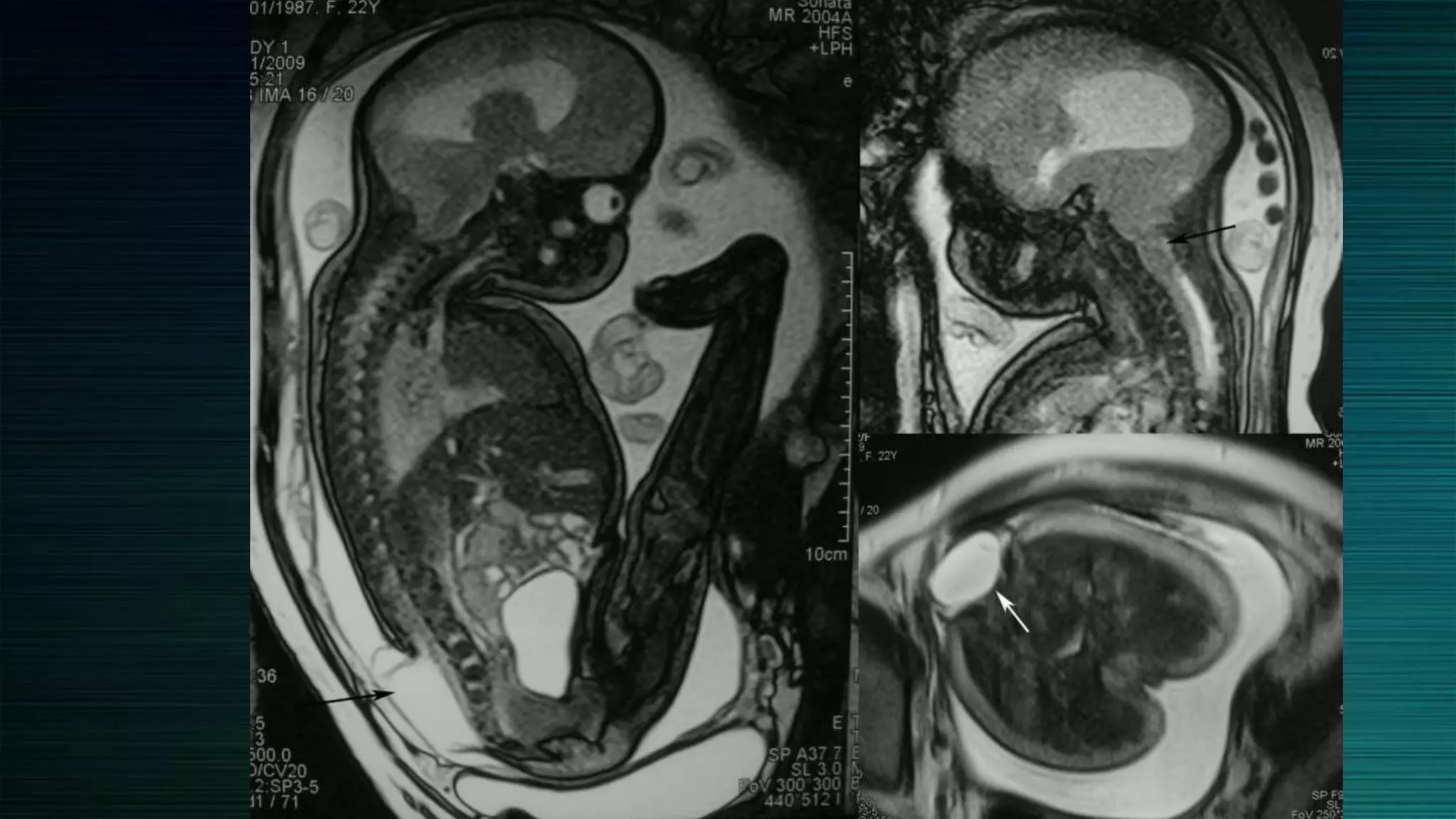 congenital brain anomalies | PPTX