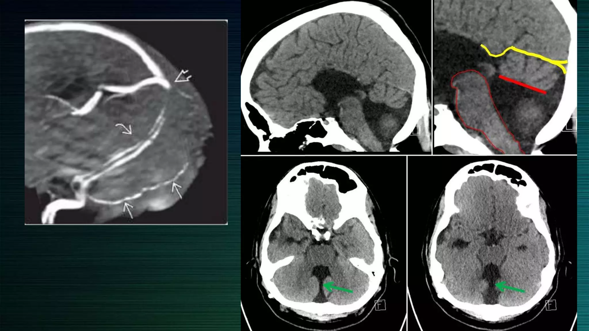 congenital brain anomalies | PPTX