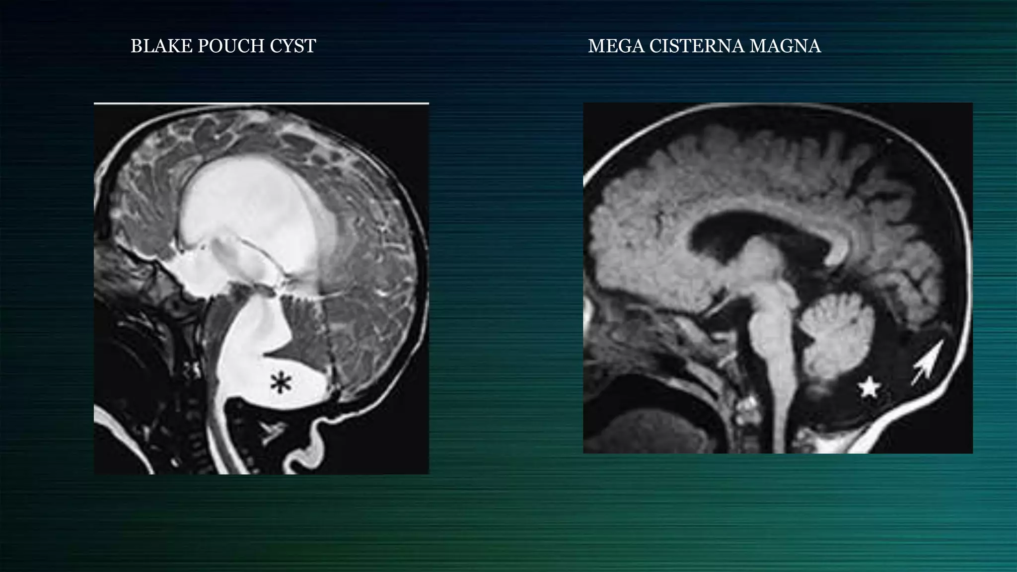 congenital brain anomalies | PPTX