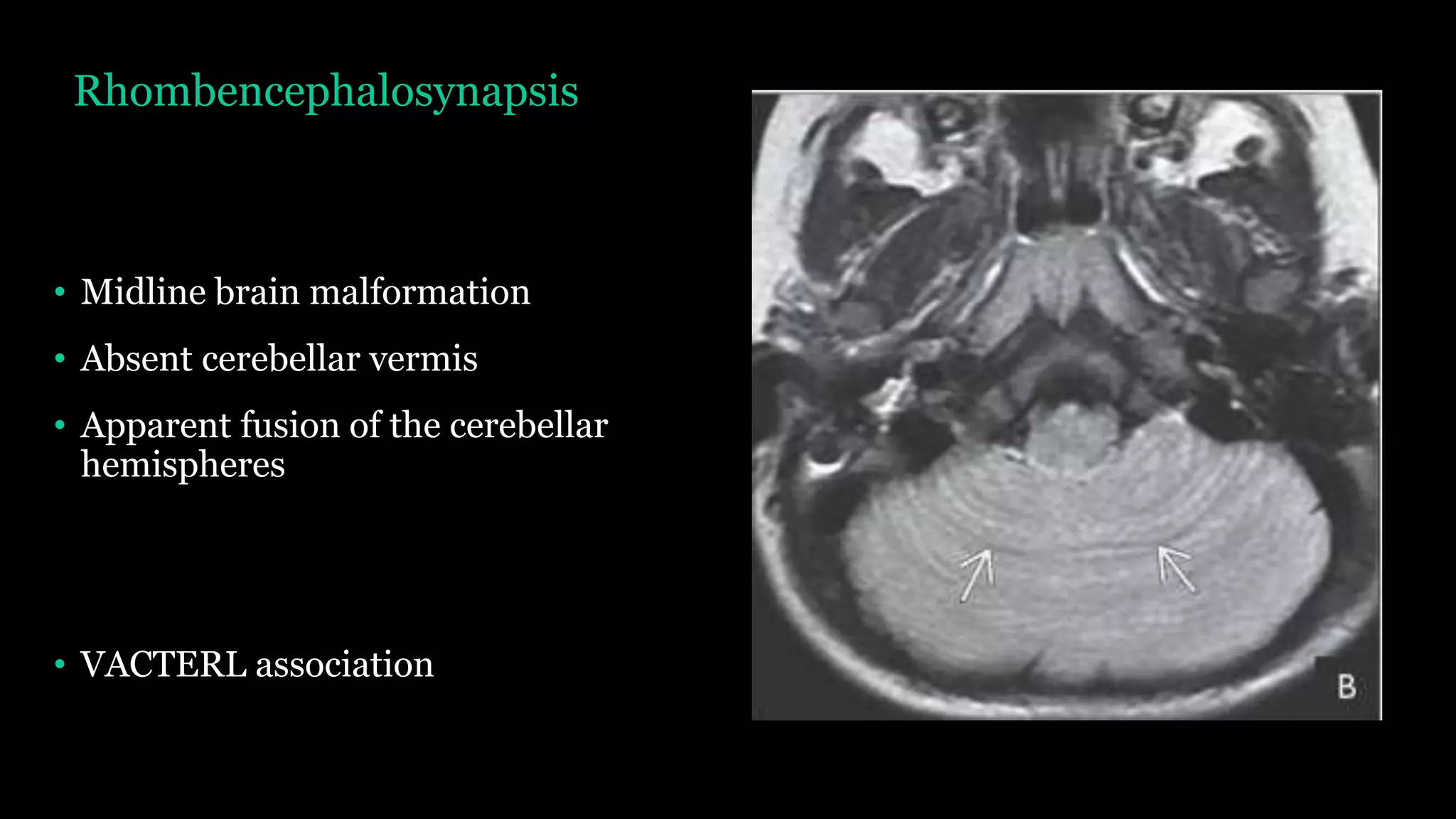 congenital brain anomalies | PPTX