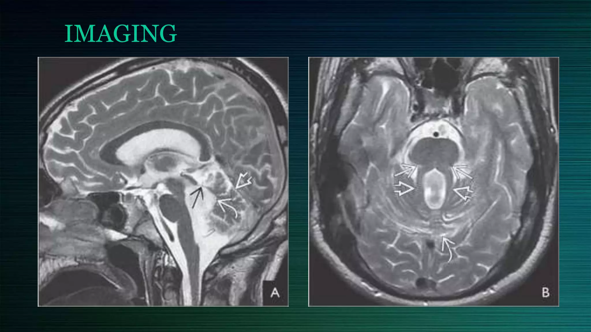 congenital brain anomalies | PPTX