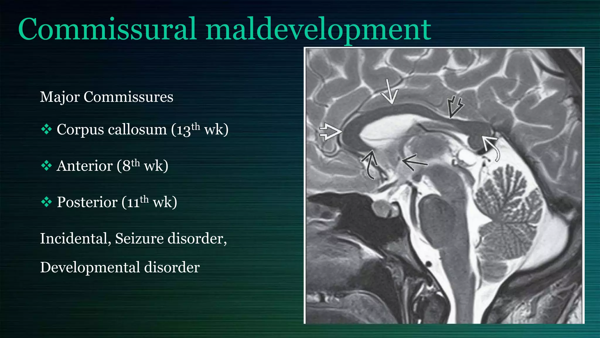 congenital brain anomalies | PPTX