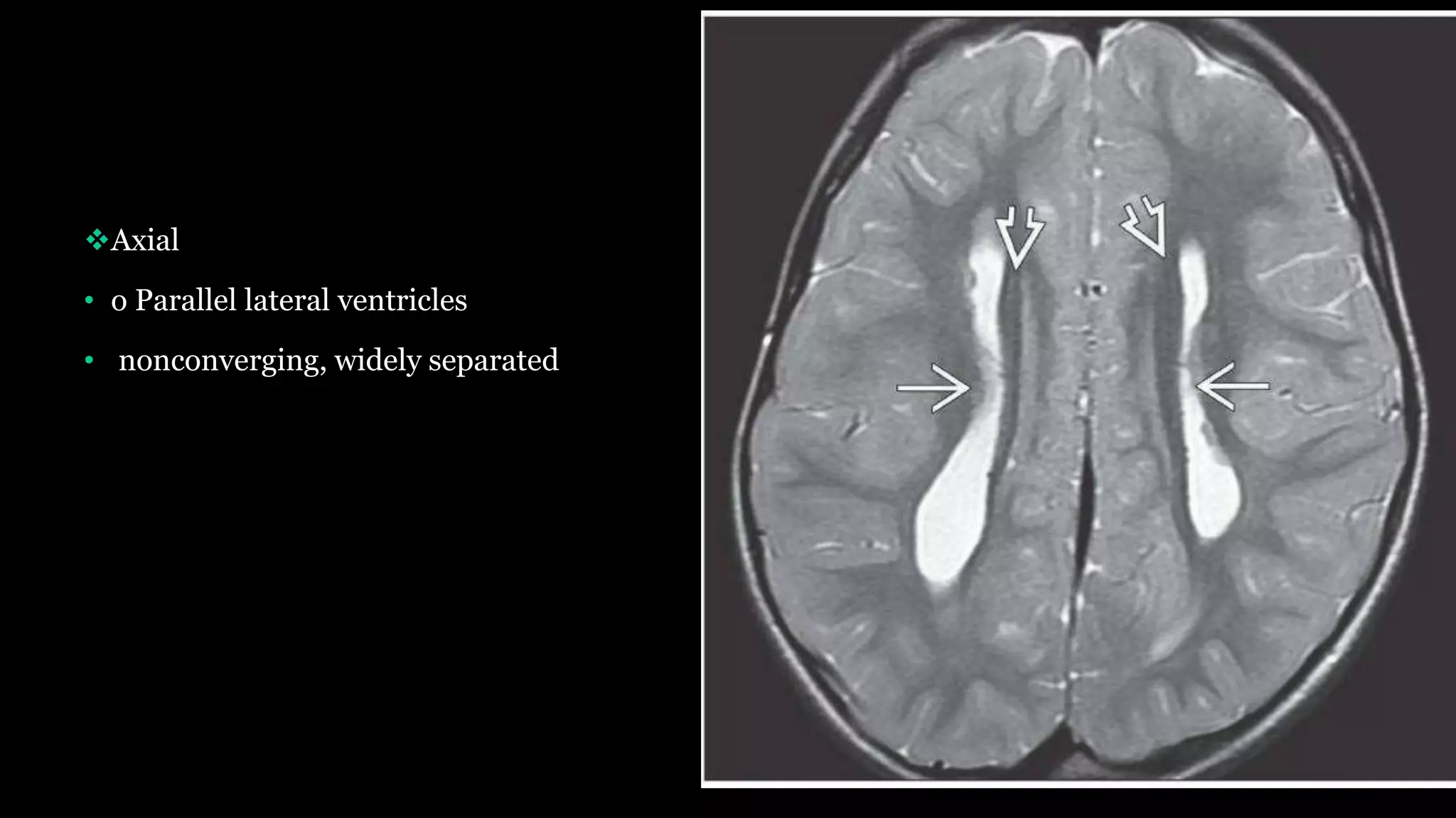 congenital brain anomalies | PPTX