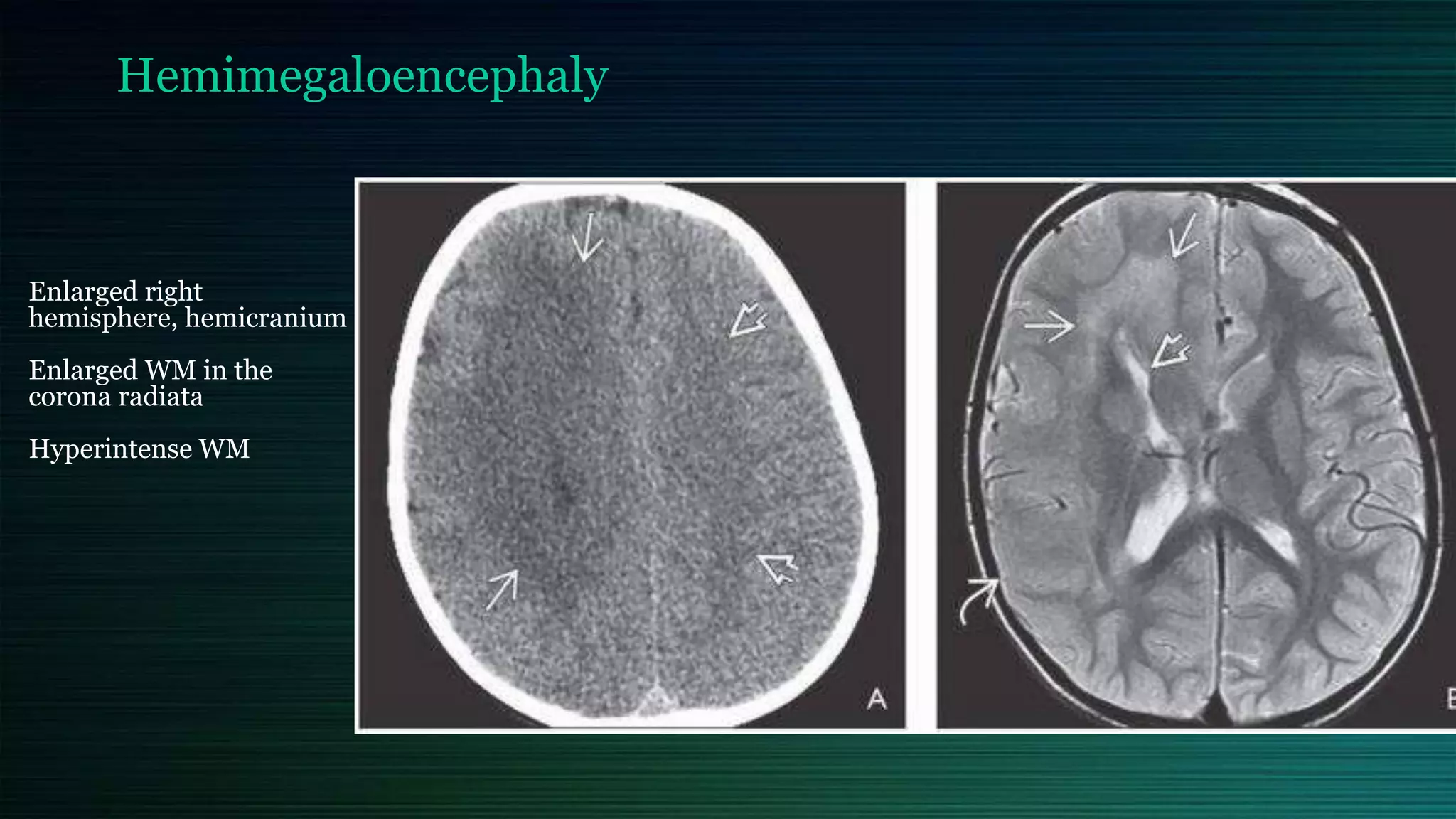 congenital brain anomalies | PPTX