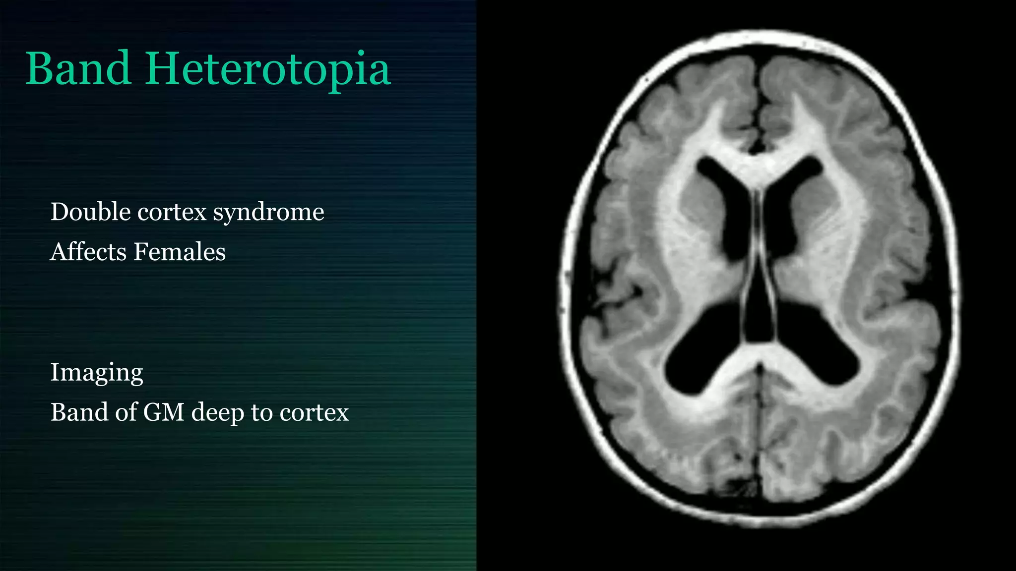 congenital brain anomalies | PPTX