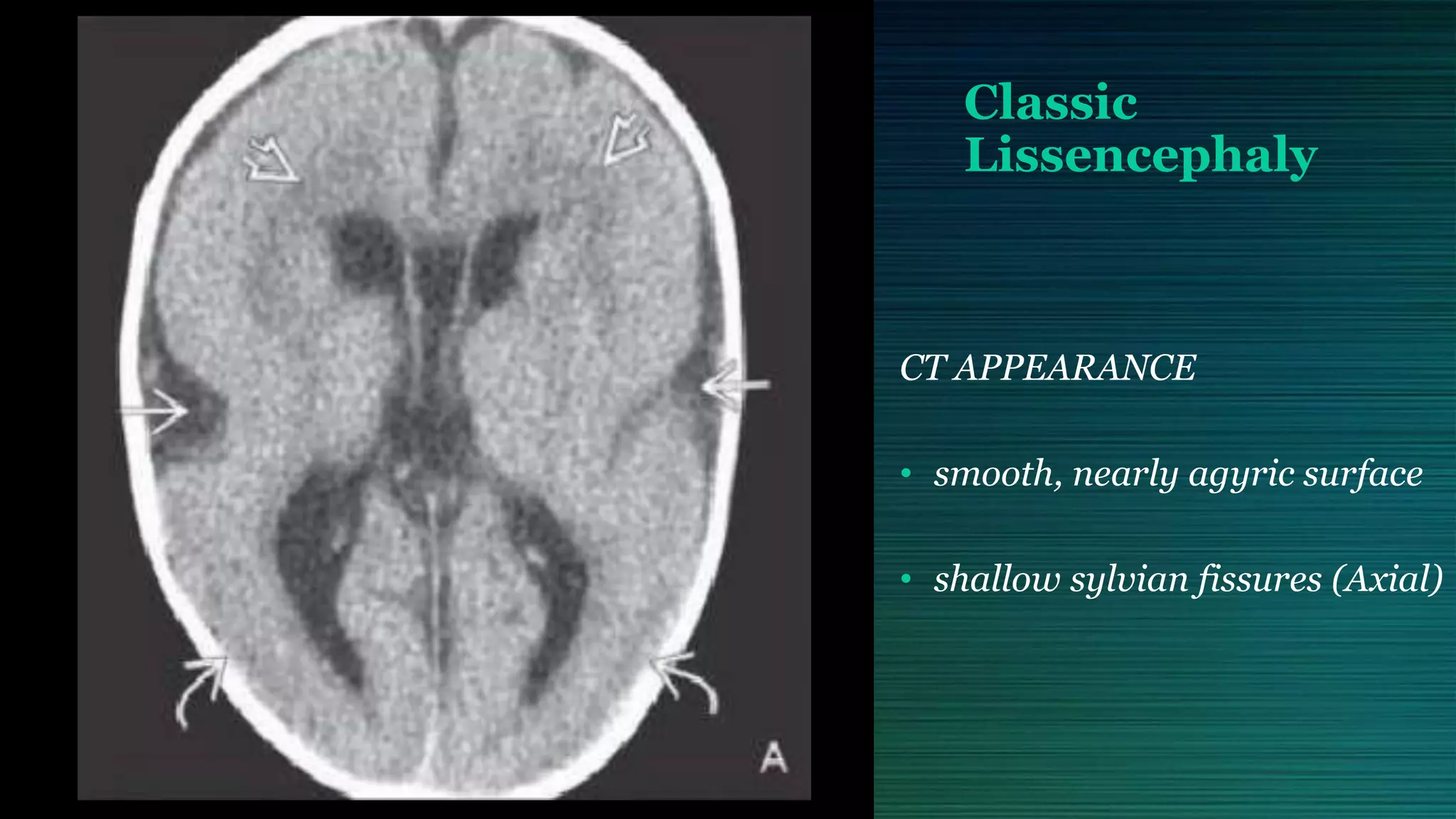 congenital brain anomalies | PPTX