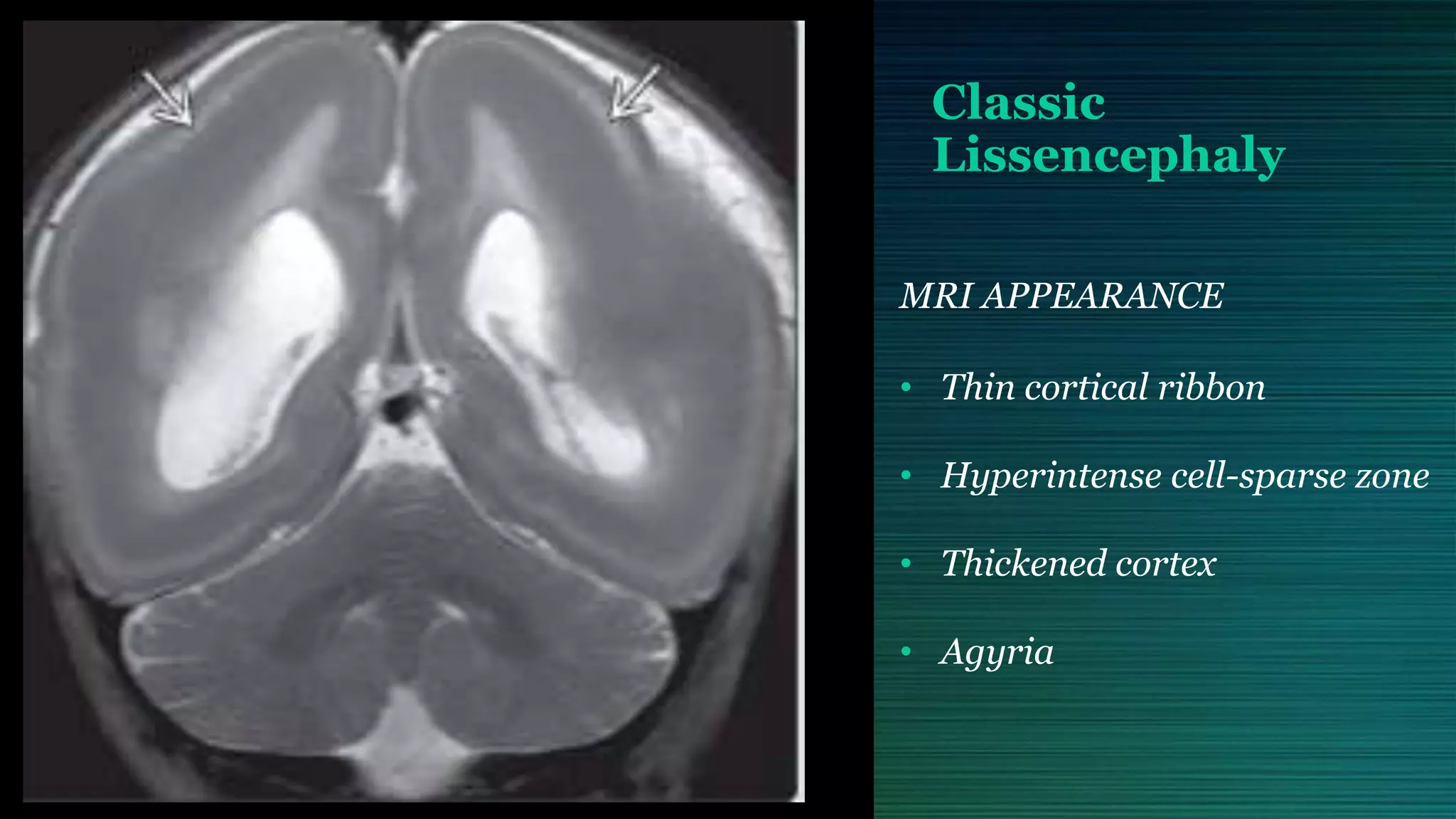 congenital brain anomalies | PPTX