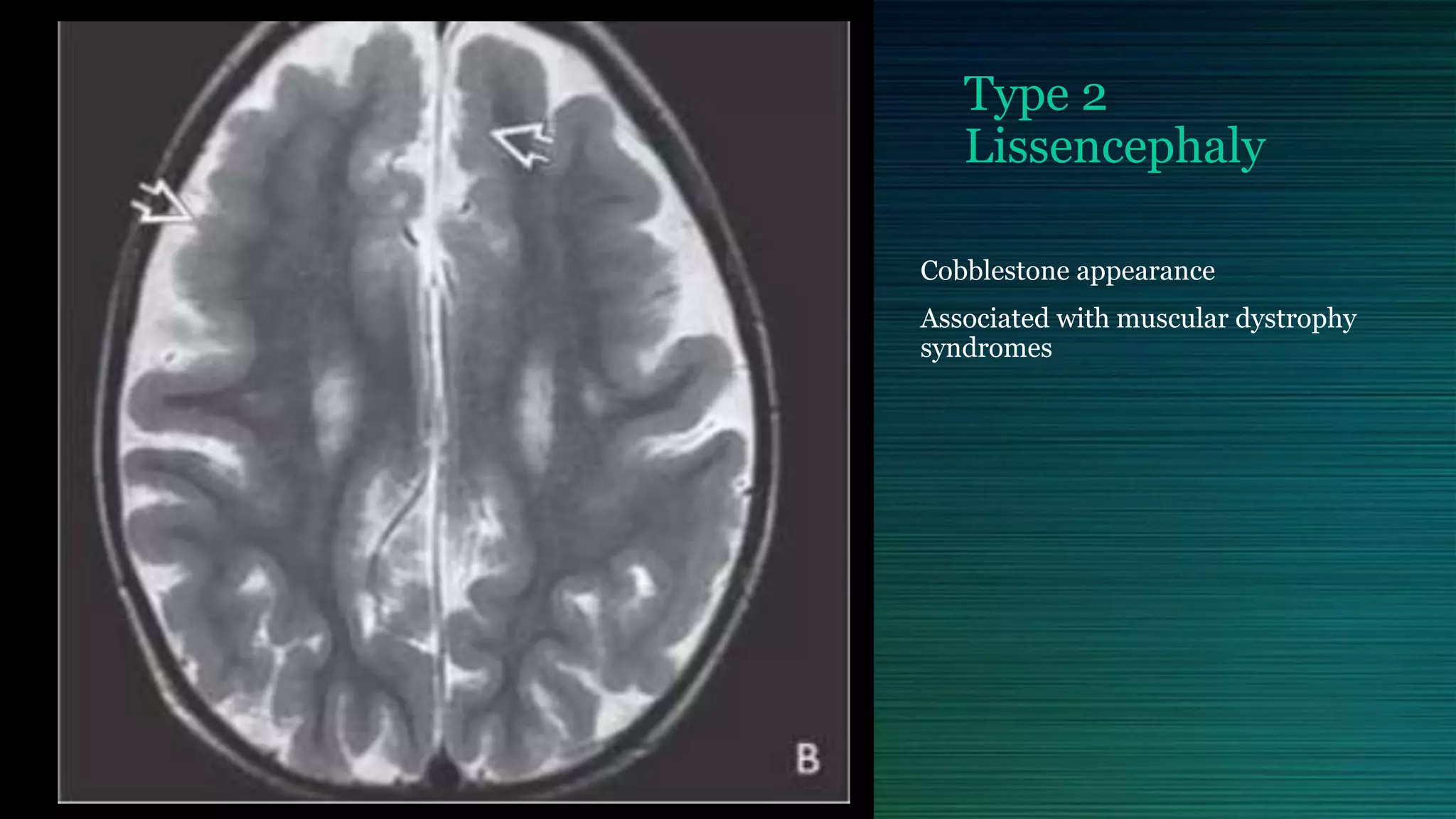 congenital brain anomalies | PPTX