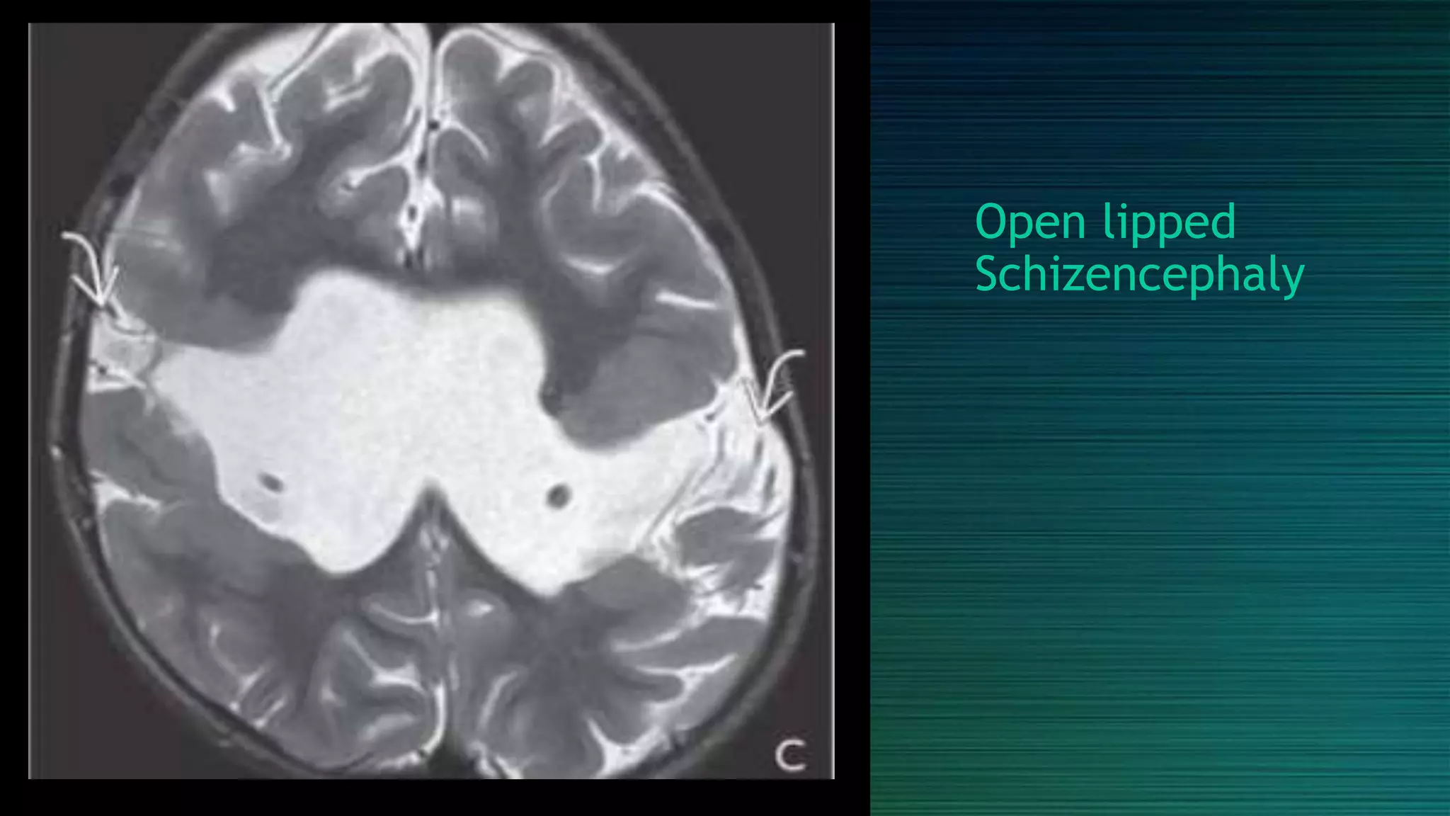 congenital brain anomalies | PPTX