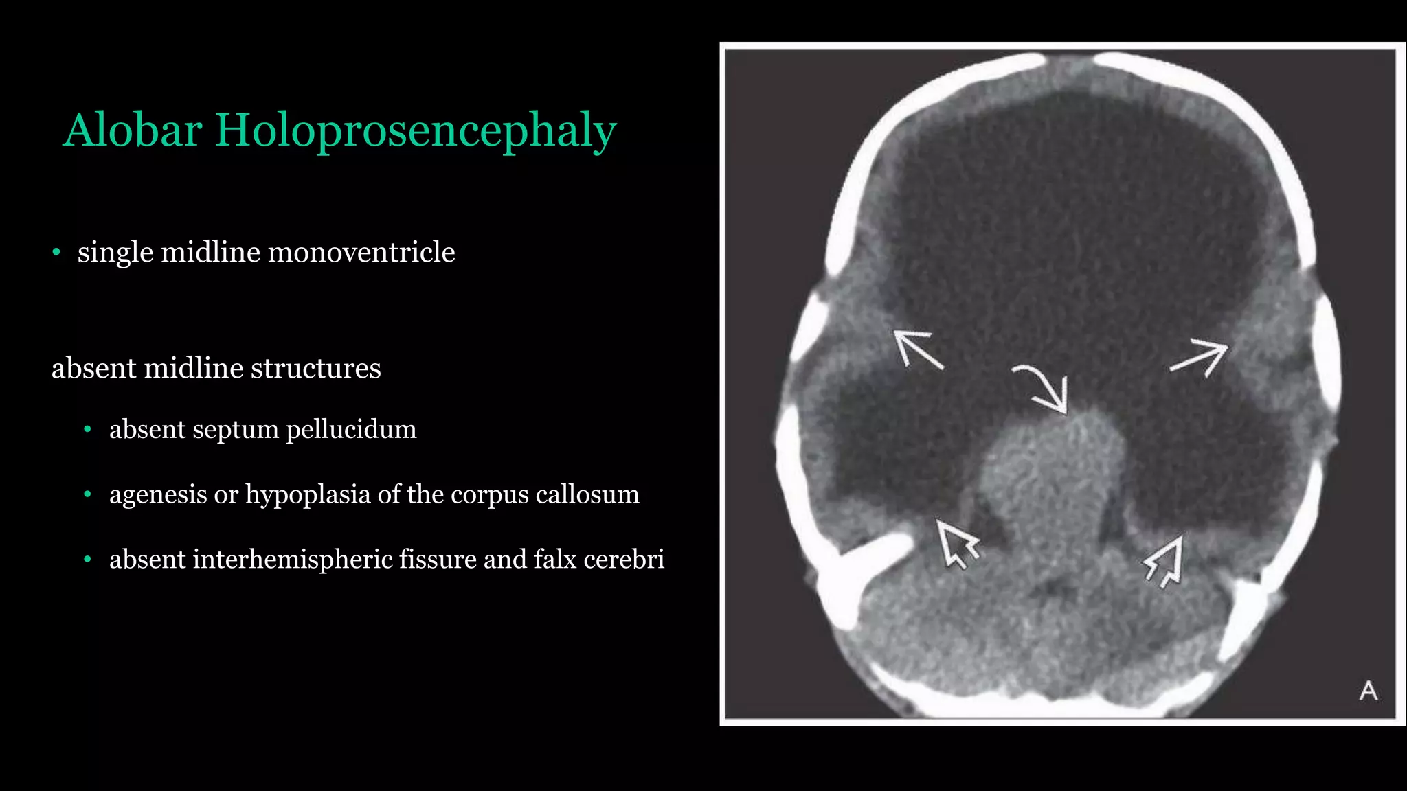 congenital brain anomalies | PPTX
