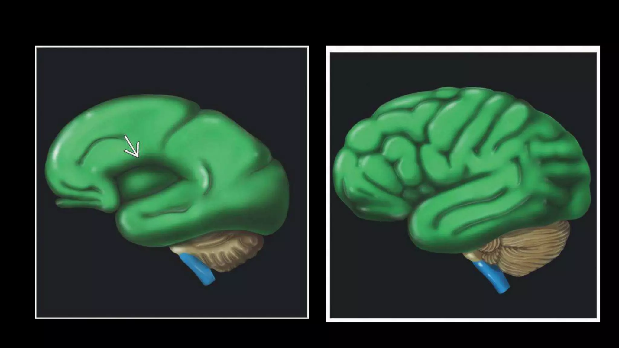 congenital brain anomalies | PPTX