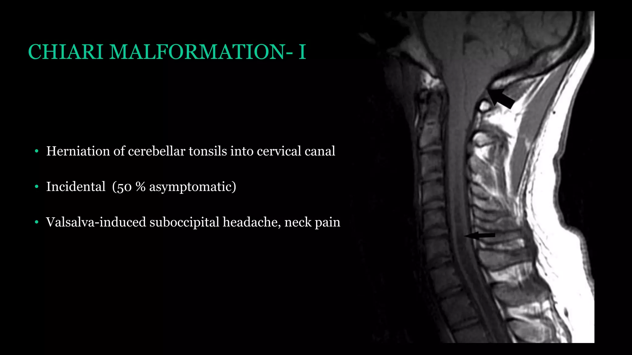congenital brain anomalies | PPTX