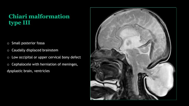 congenital brain anomalies | PPTX | Brain and Nervous System Disorders ...