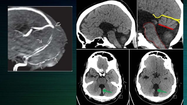 congenital brain anomalies | PPTX | Brain and Nervous System Disorders ...